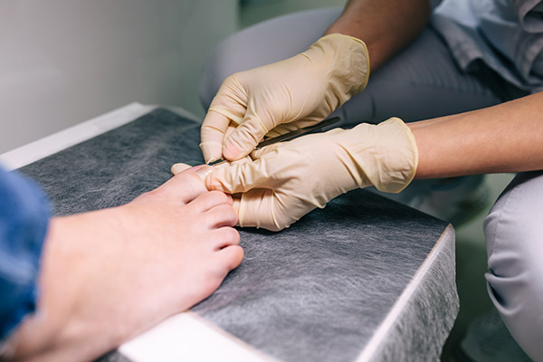 ¿Qué le ocurre a la uña durante la quimioterapia o radioterapia?